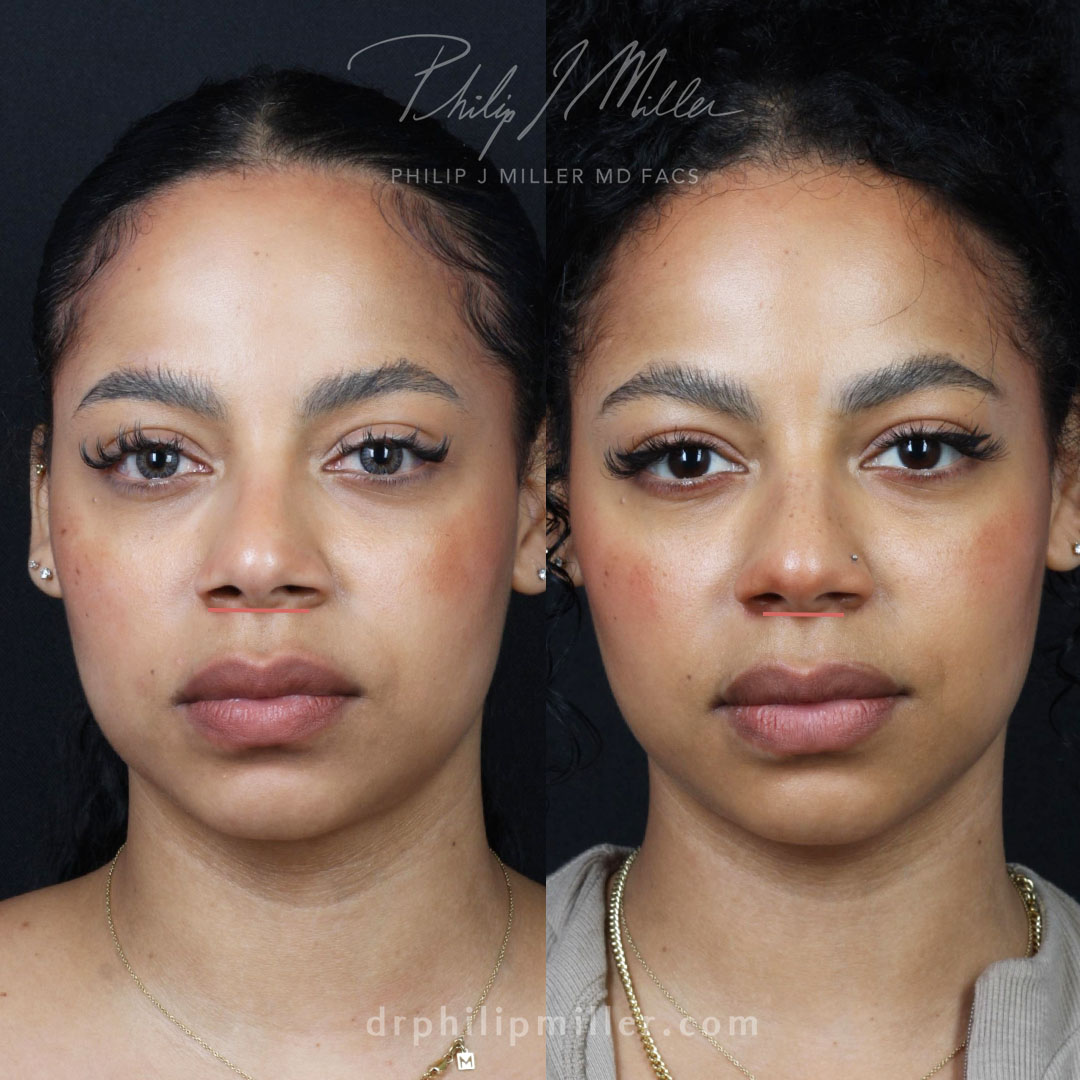 Patient 201060187 | Alar Base Reduction Before & After Photos | Philip ...