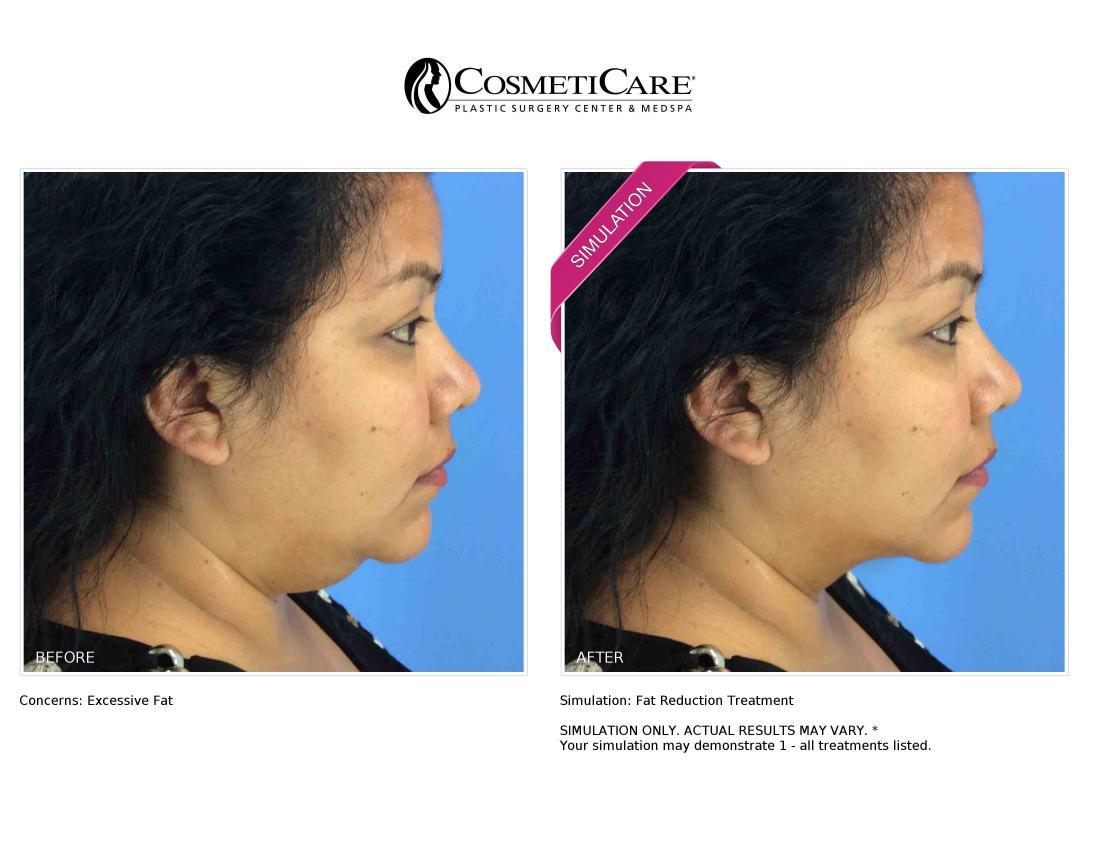 Check out your ‘New Look Now’ for your Kybella Treatments at ...