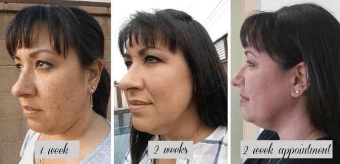 Kybella Results - My Transformation - CosmetiCare