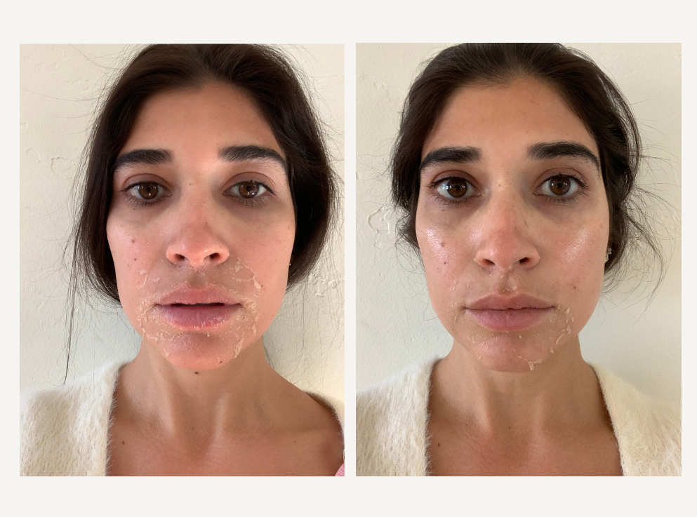 The Top 5 Reasons You Should Peel - CosmetiCare