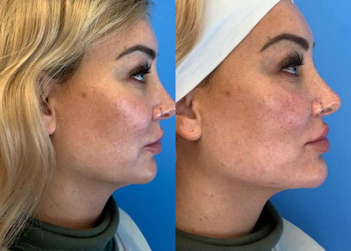 Best Filler For Face l CosmetiCare