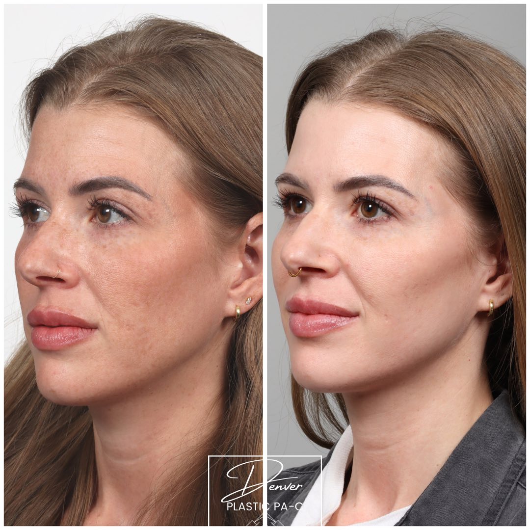 Sciton BBL Denver | Peak Plastic Surgery Center