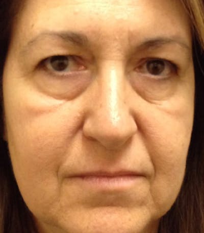 Upper Blepharoplasty Gallery | Kyle Cox MD Ocufacial Surgery & Aesthetics