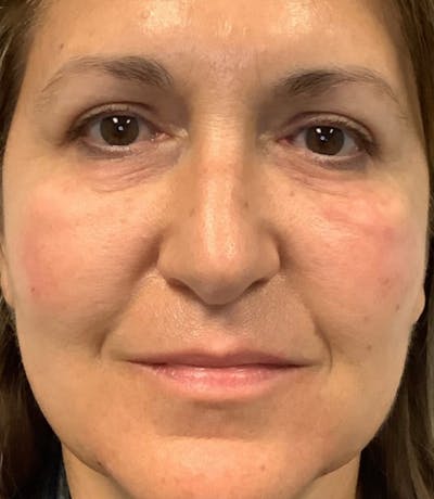 Upper Blepharoplasty Gallery | Kyle Cox MD Ocufacial Surgery & Aesthetics