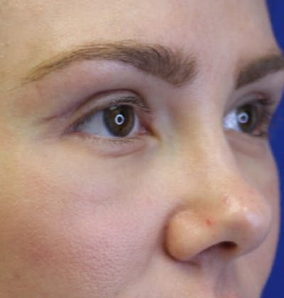 Upper Blepharoplasty Gallery | Kyle Cox MD Ocufacial Surgery & Aesthetics