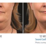 Does CoolSculpting® Improve the Appearance of Lax Tissue? - The ...