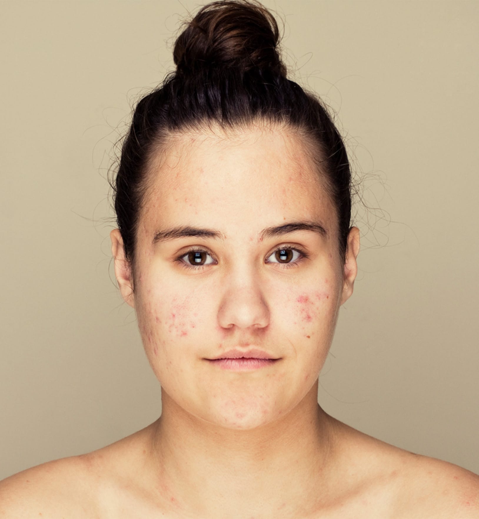 Acne Treatment Fredericksburg | The Dermatology Center