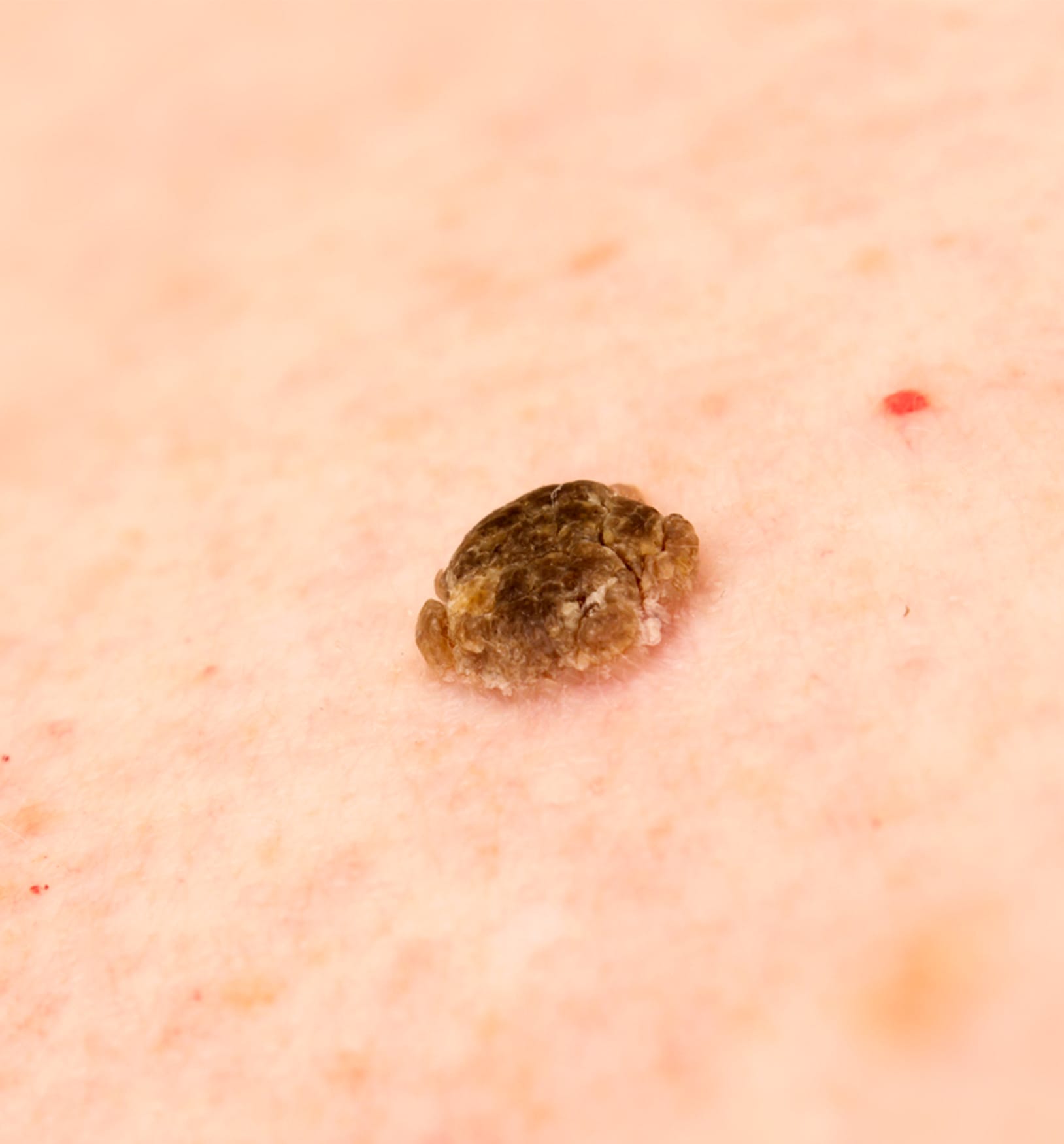 Seborrheic Actinic Keratosis The Dermatology Center