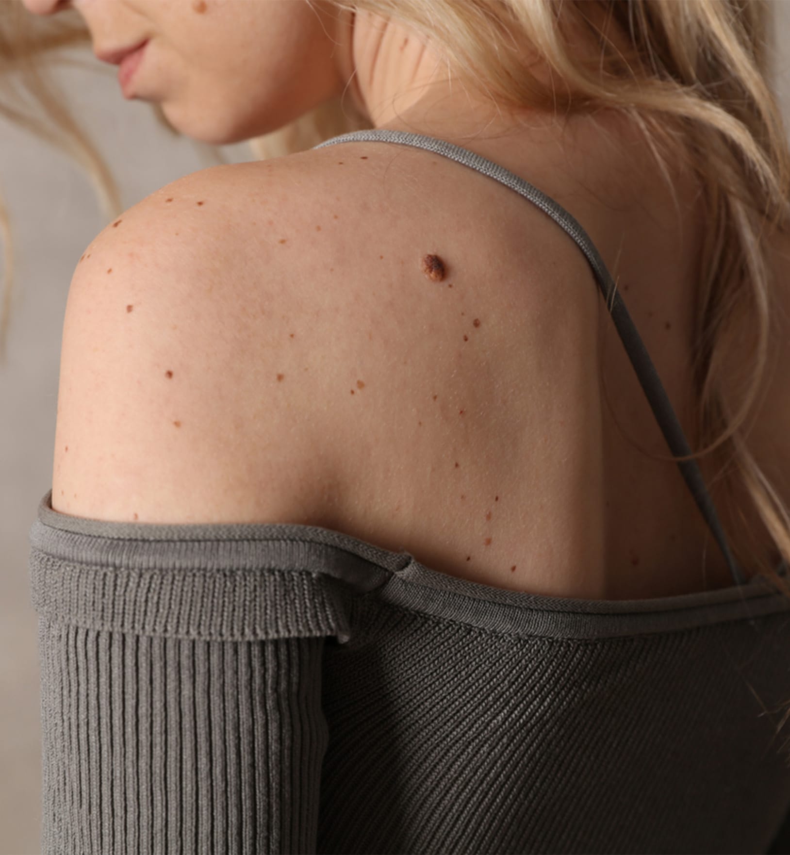 Dermal Lesions Fredericksburg The Dermatology Center