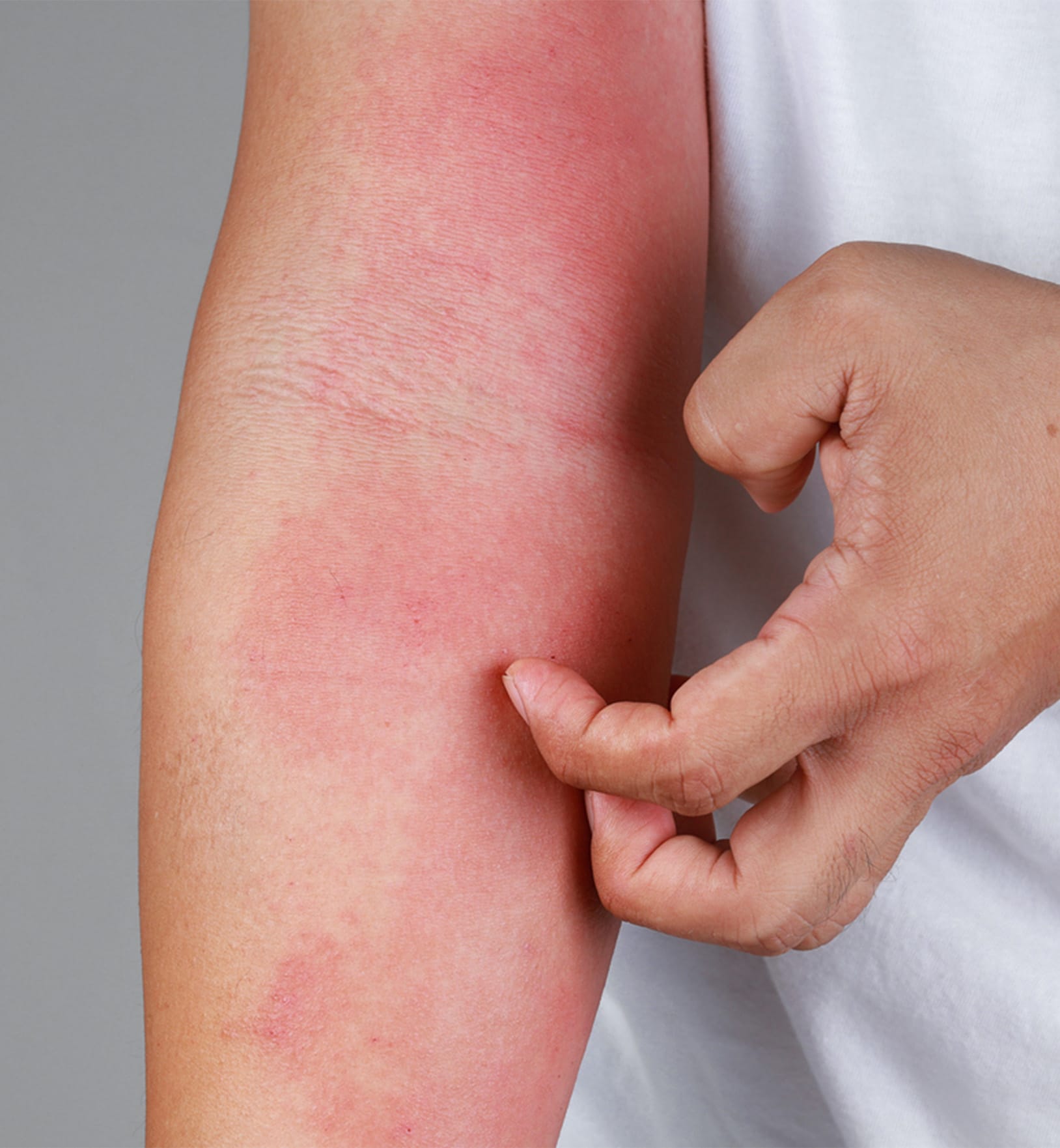 Dermatitis | The Dermatology Center