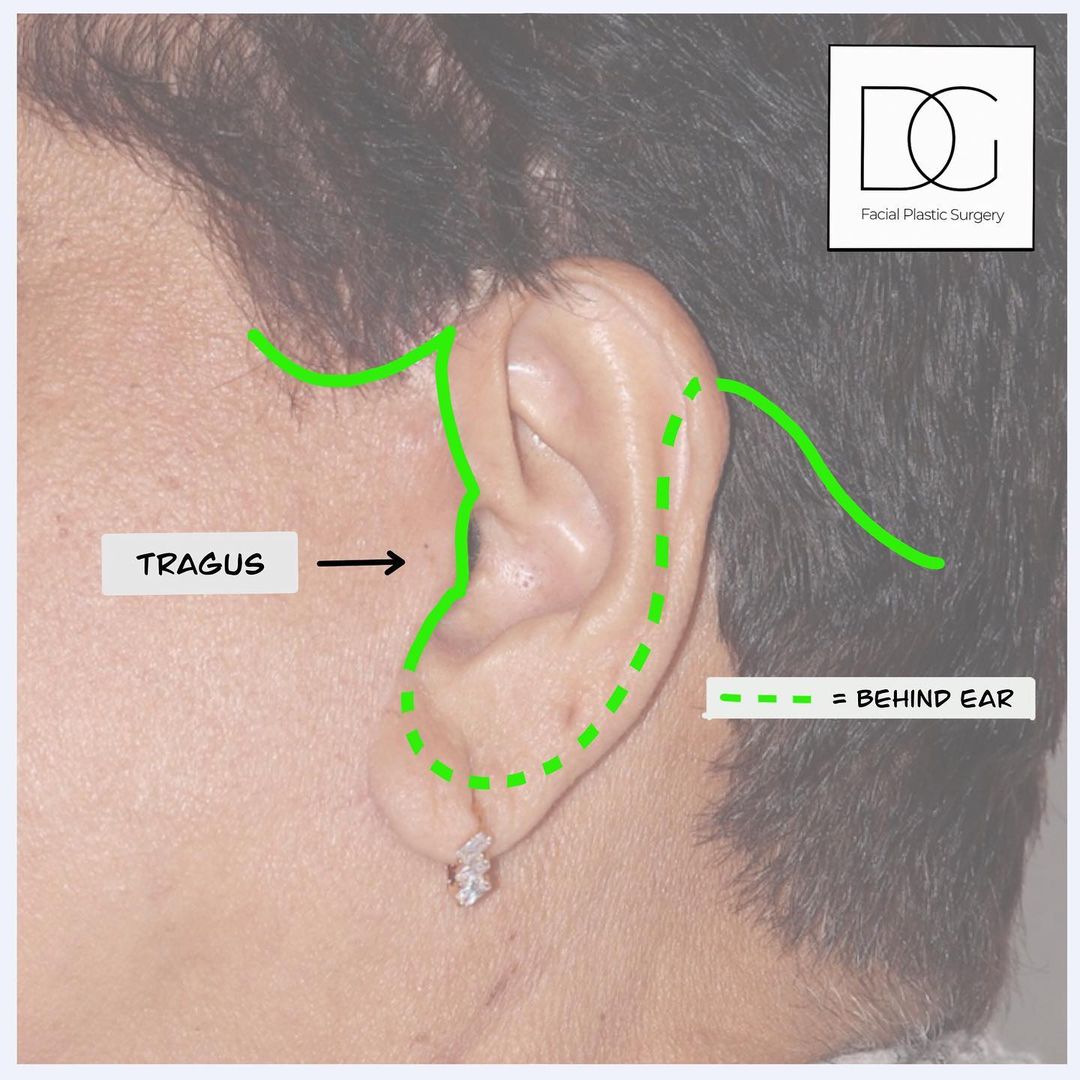 Will My Incision Be Visible After a Facelift? - Facial Plastic Surgeon ...