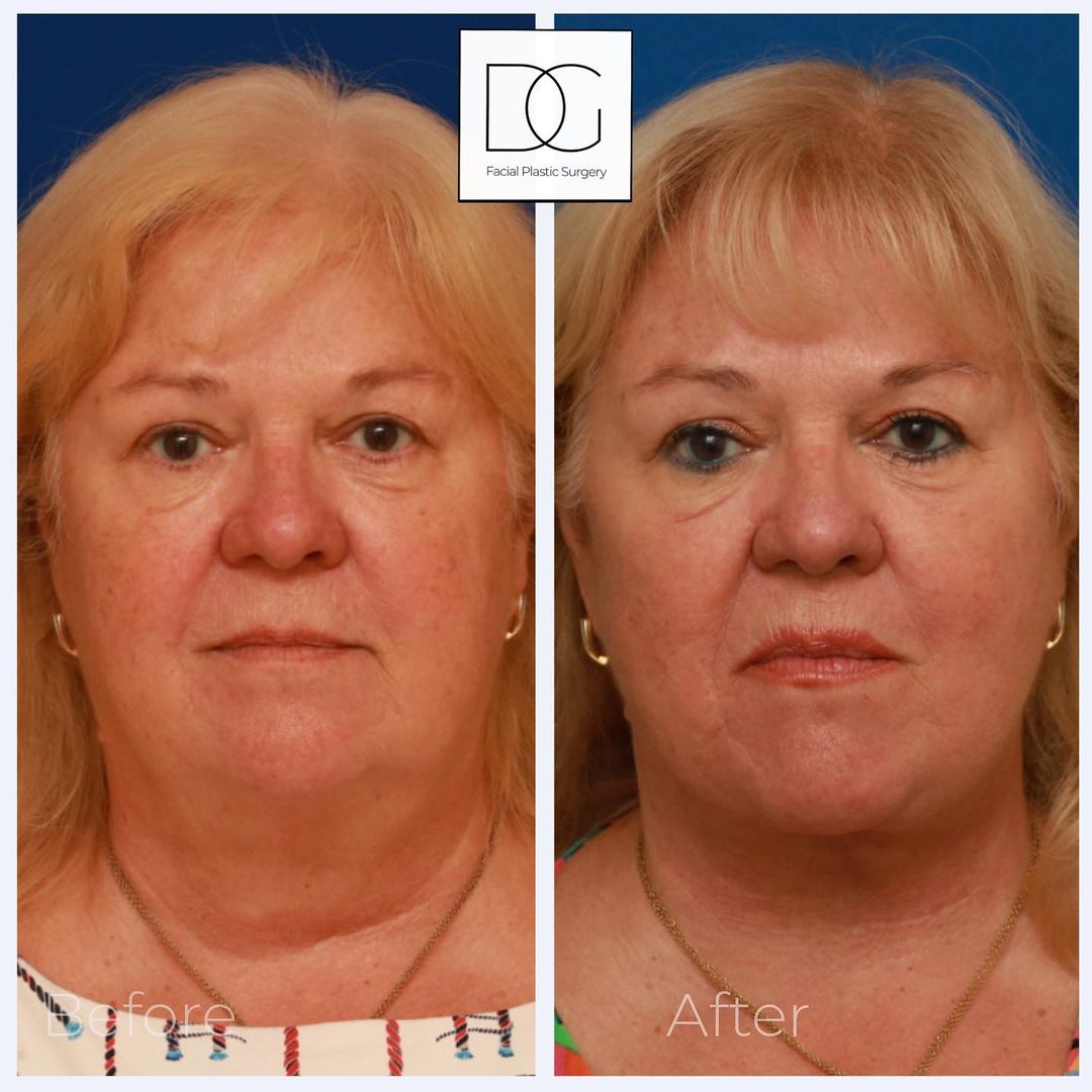 Deep Plane Face and Neck Lift: Before & After - Facial Plastic Surgeon ...