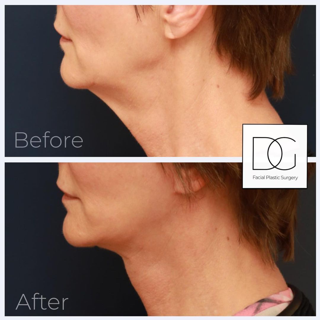 Deep Plane Neck Lift Before & After Results - Facial Plastic Surgeon ...