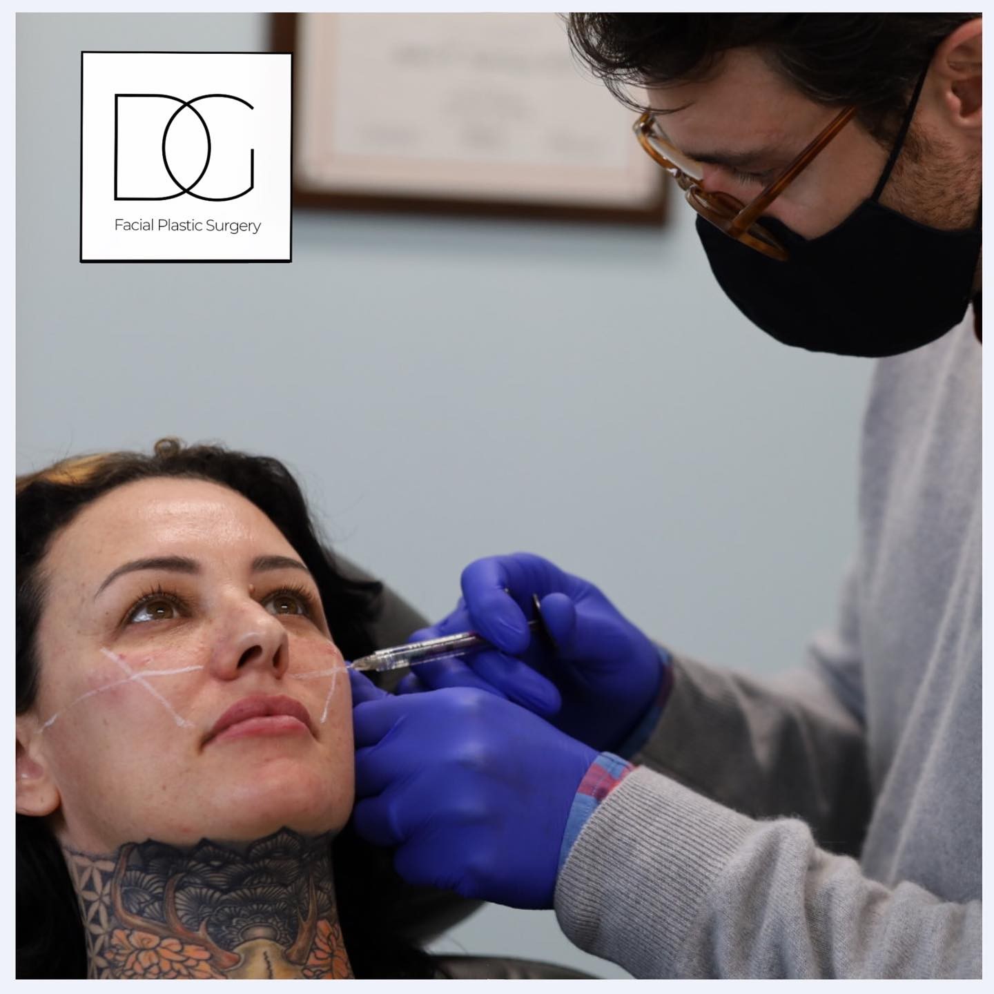 Midface Filler Augmentation - Facial Plastic Surgeon | Palo Alto | San ...