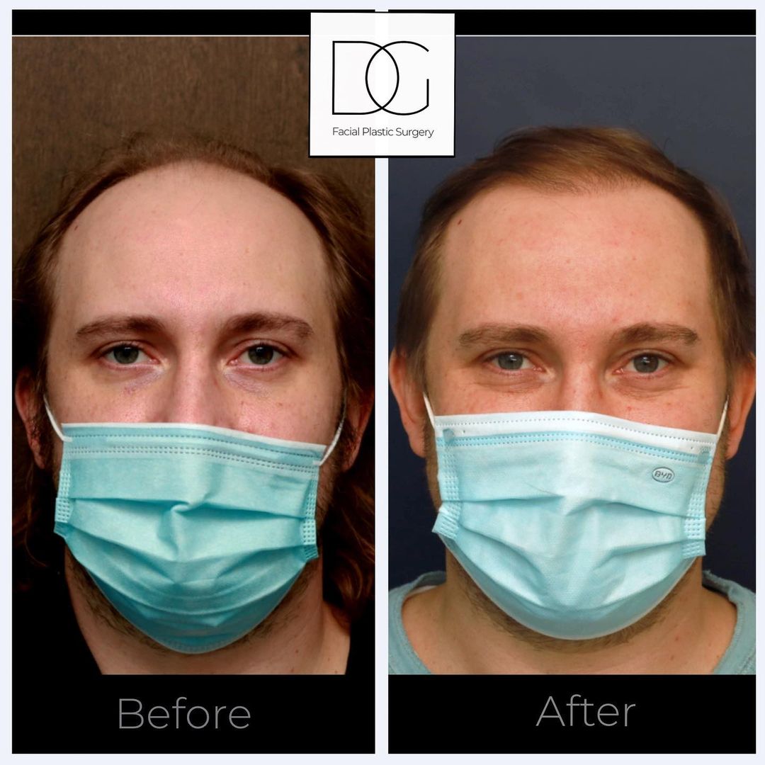 Hair Restoration for Premature Androgenic Alopecia - Facial Plastic ...