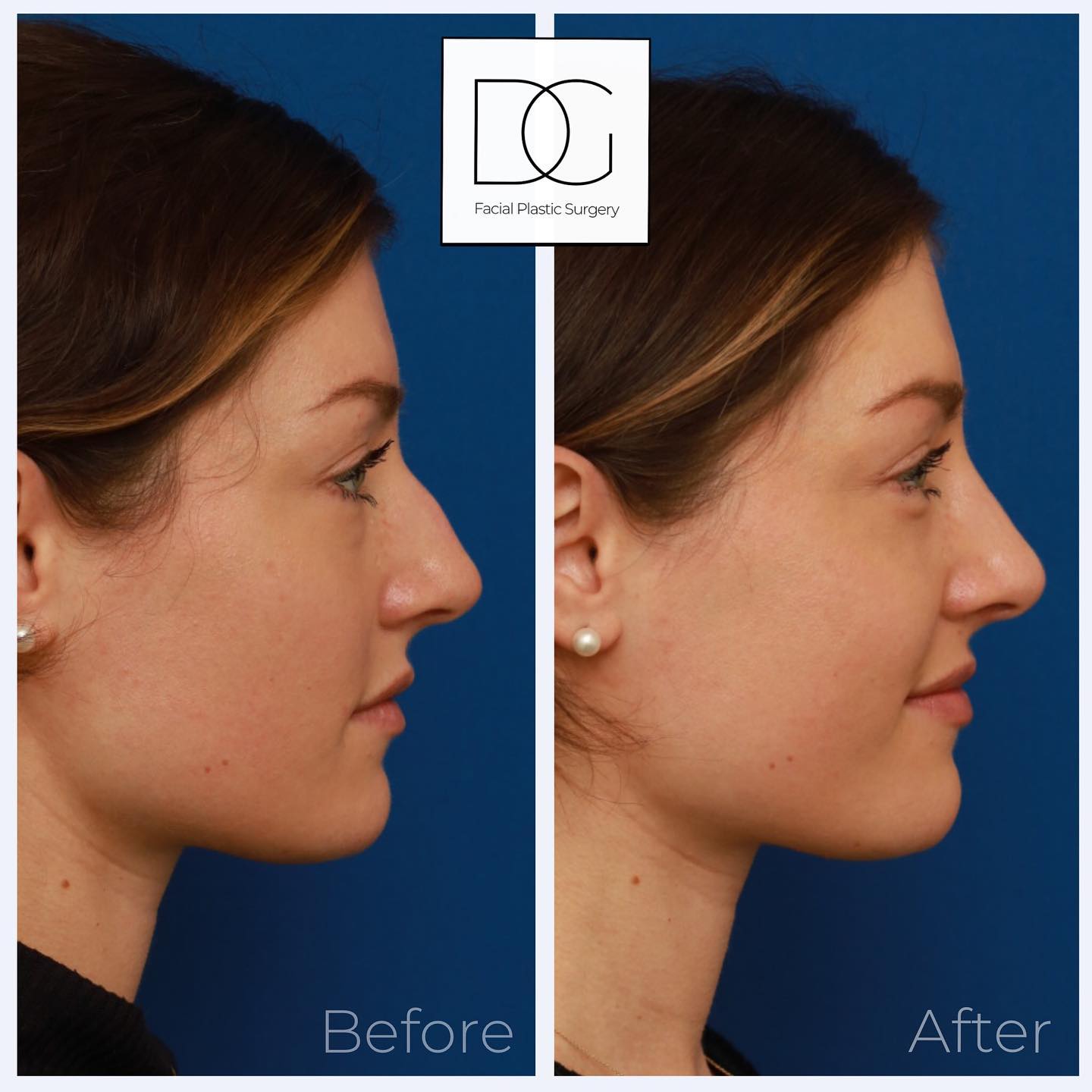 Rhinoplasty To Remove Hump on Bridge - Facial Plastic Surgeon | Palo ...