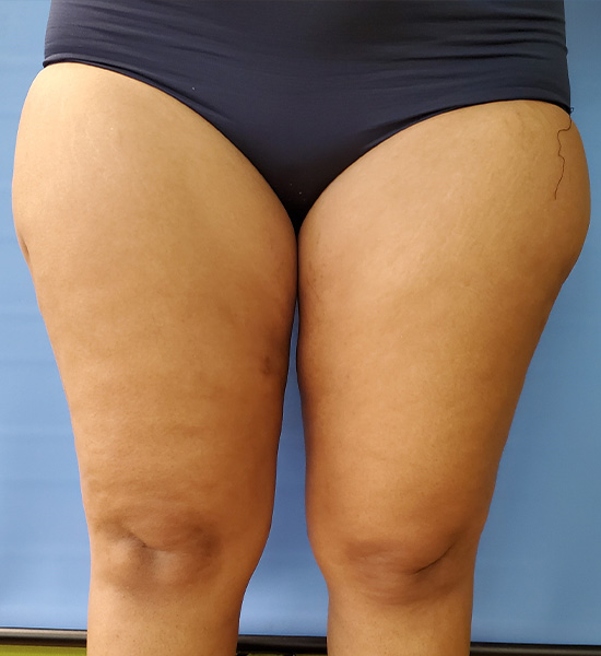 Cellulite Inner Thighs