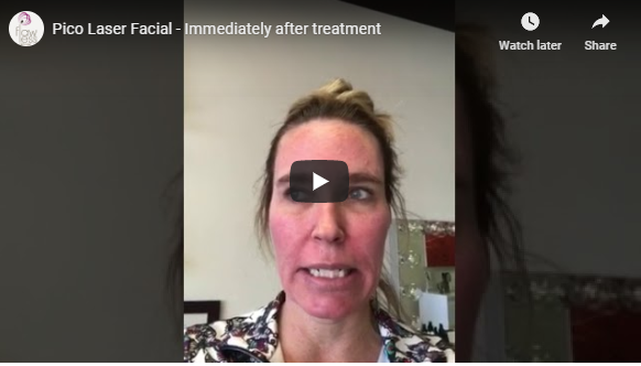 Pico Laser Facial - Immediately after treatment | Flawless Med Spa