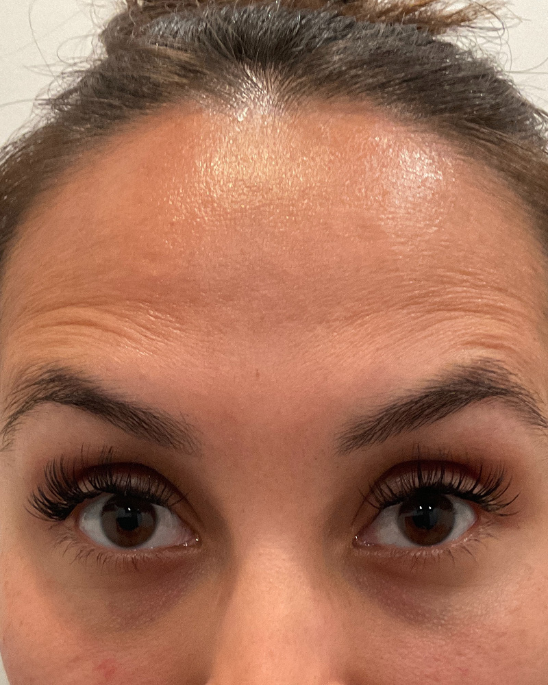 Patient 175045796 | BOTOX Before & After Photos | Flawless Medspa