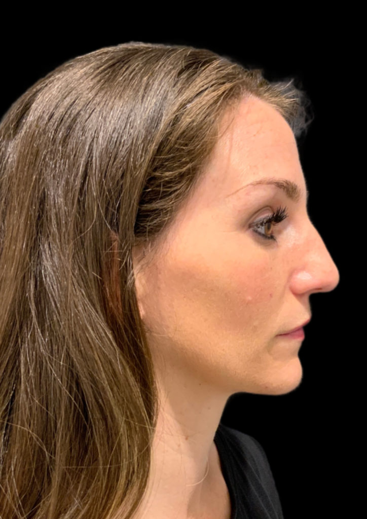 Nose Job Before And After Profile