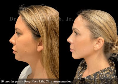 Chin Augmentation Before & After Photos | Robb Facial Plastic Surgery