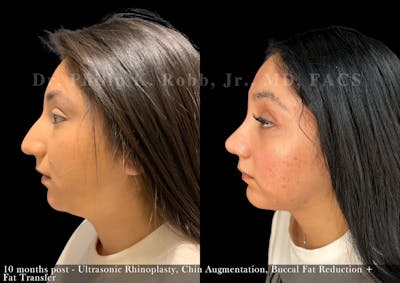 Chin Augmentation Before & After Photos | Robb Facial Plastic Surgery
