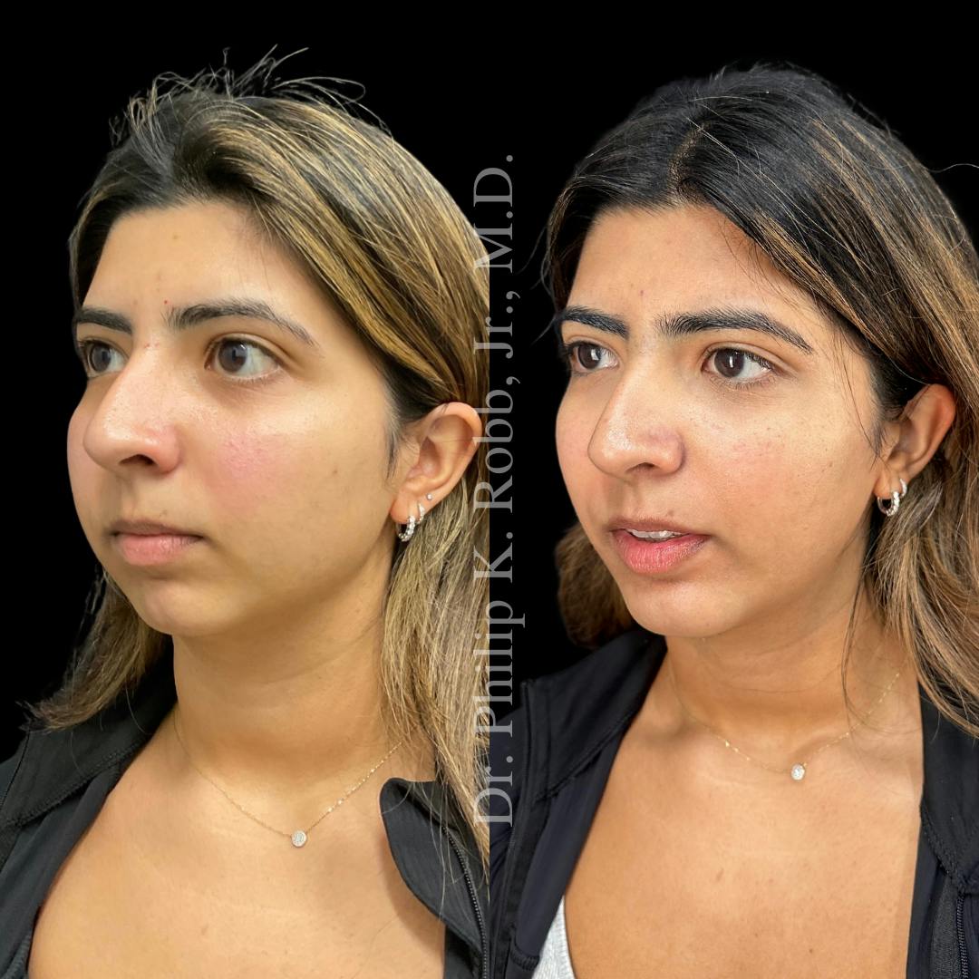 Patient 129972 | Chin Augmentation Before & After Photos | Robb Facial ...
