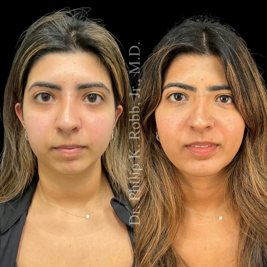 Patient 129972 | Chin Augmentation Before & After Photos | Robb Facial ...
