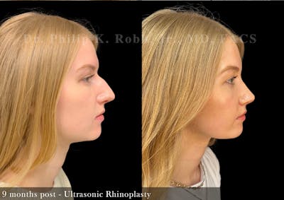 Ultrasonic Rhinoplasty Before & After Photos | Robb Facial Plastic Surgery