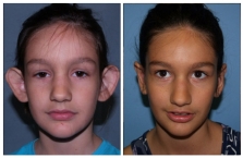 Otoplasty in Children - Gold Coast Plastic Surgery