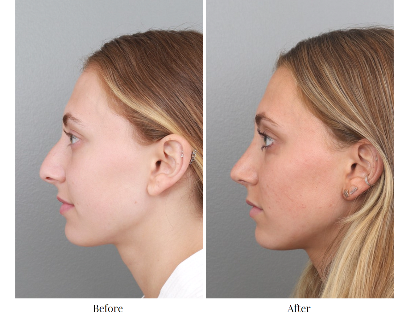 Rhinoplasty Surgeon in Chicago | Nose Job | Dr. George T. Moynihan