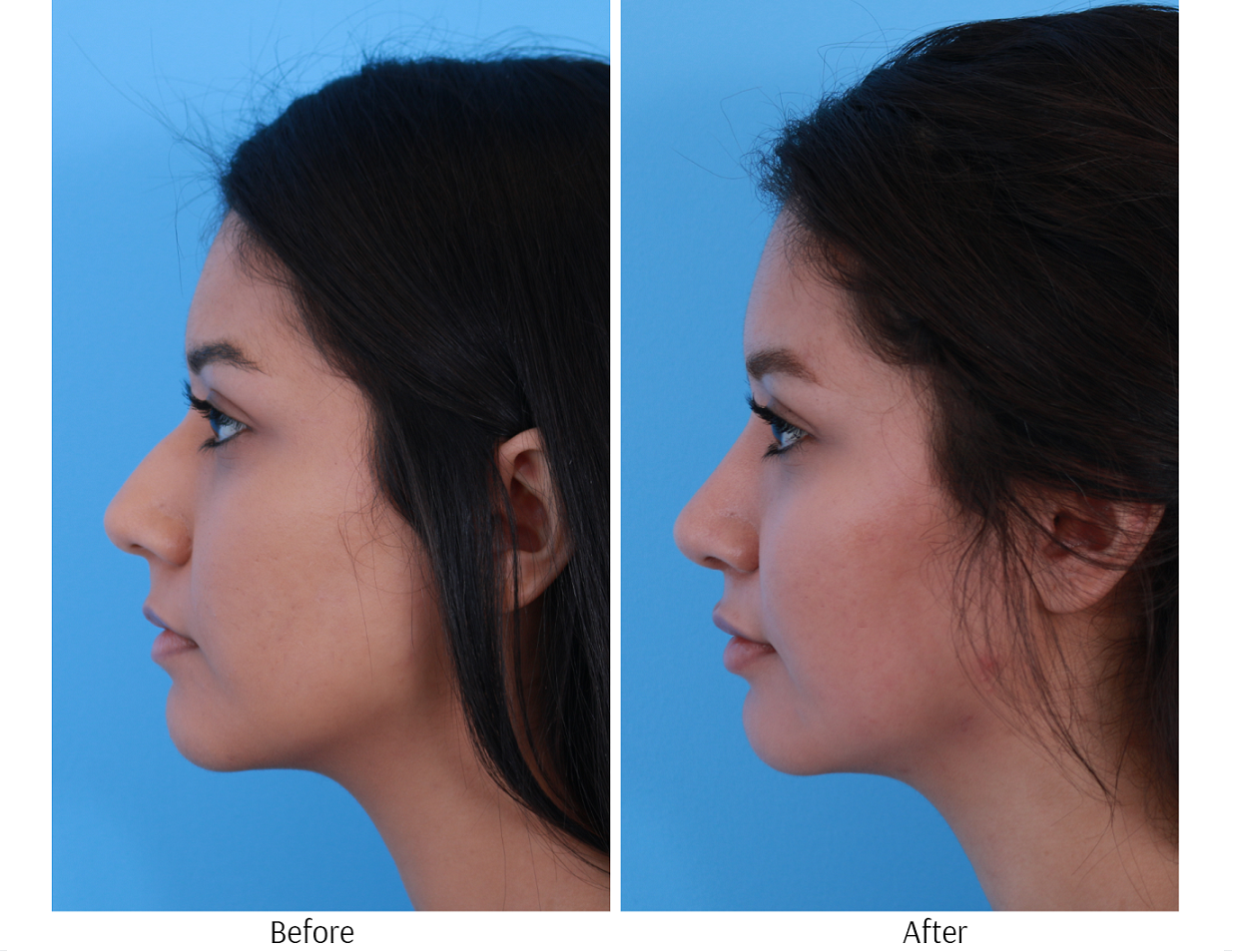 Patient 64080950 | Rhinoplasty Before & After Photos | Gold Coast ...