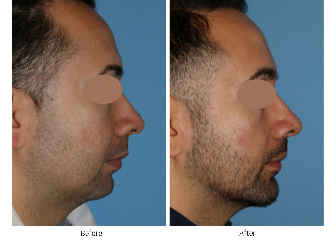 Male Jaw Implant Before And After