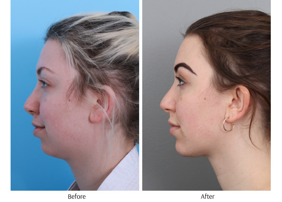 Patient 64081105 | Chin Augmentation Before & After Photos | Gold Coast ...