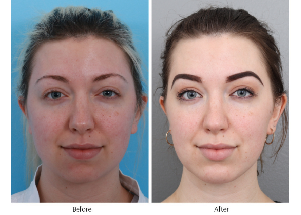 Patient 64081105 | Chin Augmentation Before & After Photos | Gold Coast ...