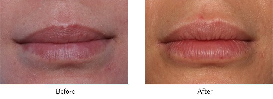 Lip Augmentation | Chicago | Naperville | GoldCoastPlasticSurgery.com