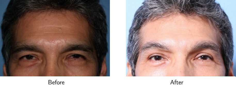 Brow Lift Chicago | Forehead Lift in Chicago, IL