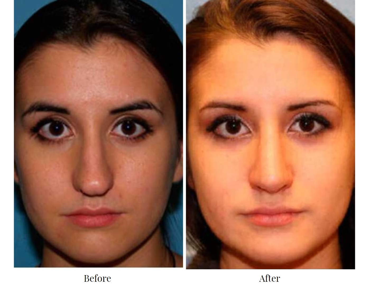 Patient 64080947 | Rhinoplasty Before & After Photos | Gold Coast ...