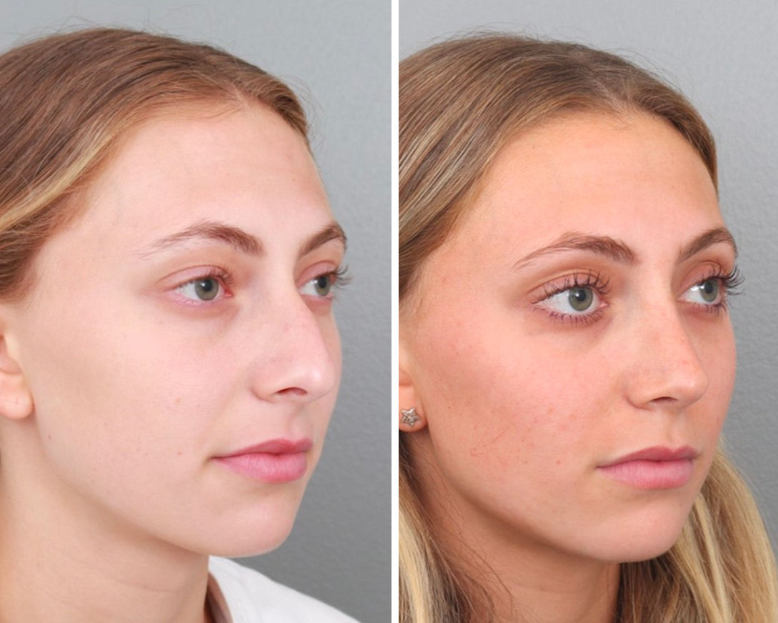 Before And After Nose Job