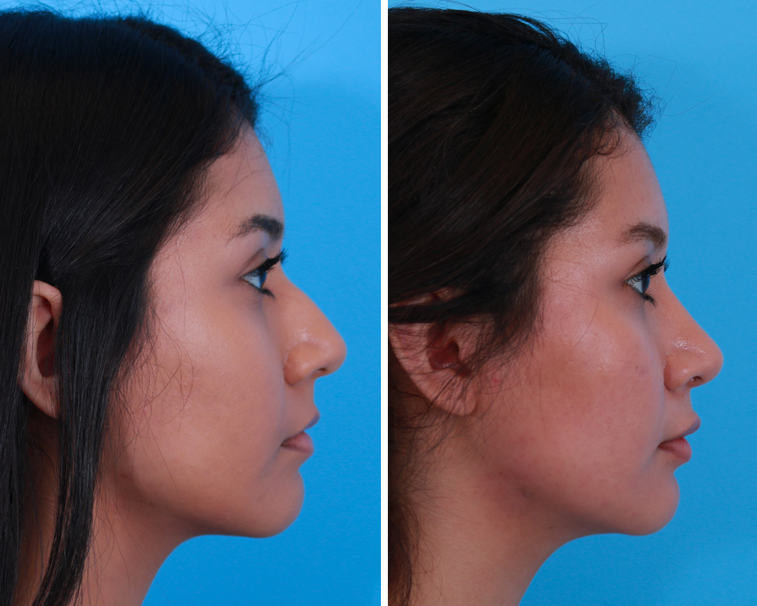 Patient 64080945 | Rhinoplasty Before & After Photos | Gold Coast ...