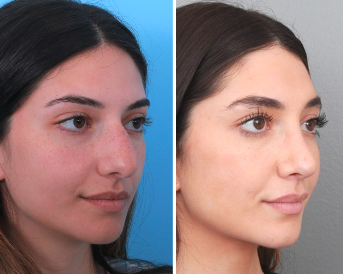 Patient 64080951 | Rhinoplasty Before & After Photos | Gold Coast ...