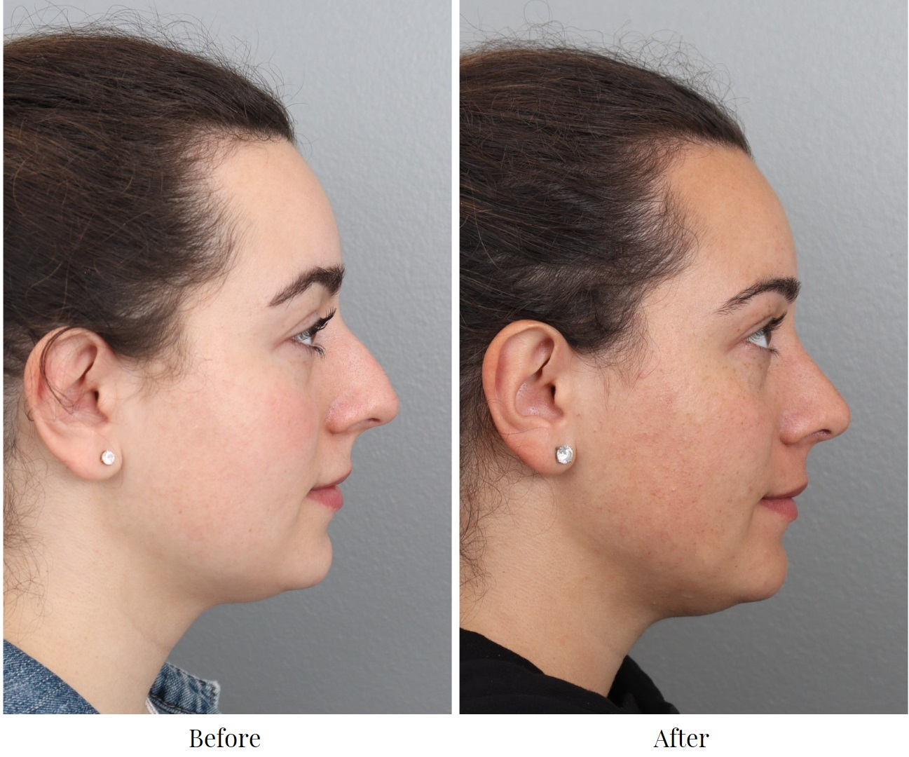 Patient 64080983 | Rhinoplasty Before & After Photos | Gold Coast ...
