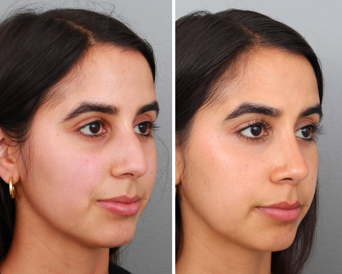 Patient 73471214 | Rhinoplasty Before & After Photos | Gold Coast ...