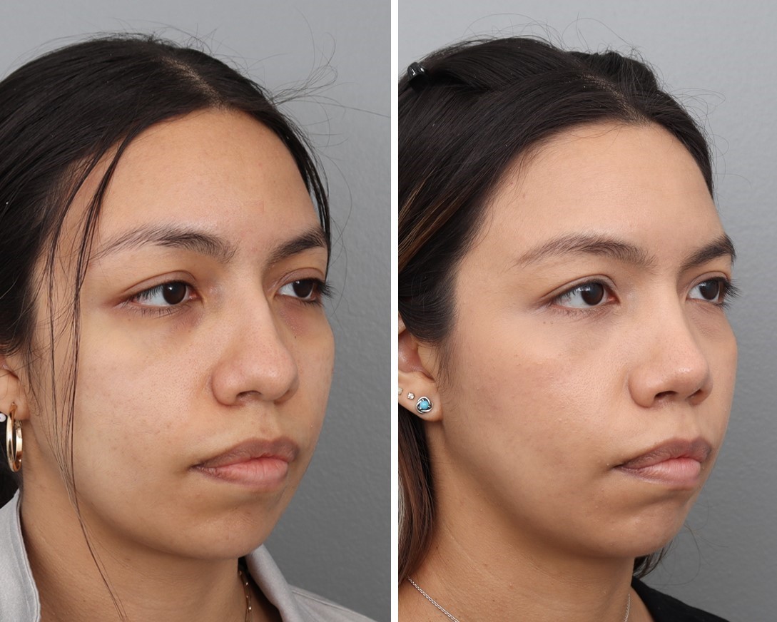 Patient 64081050 | Rhinoplasty Before & After Photos | Gold Coast ...