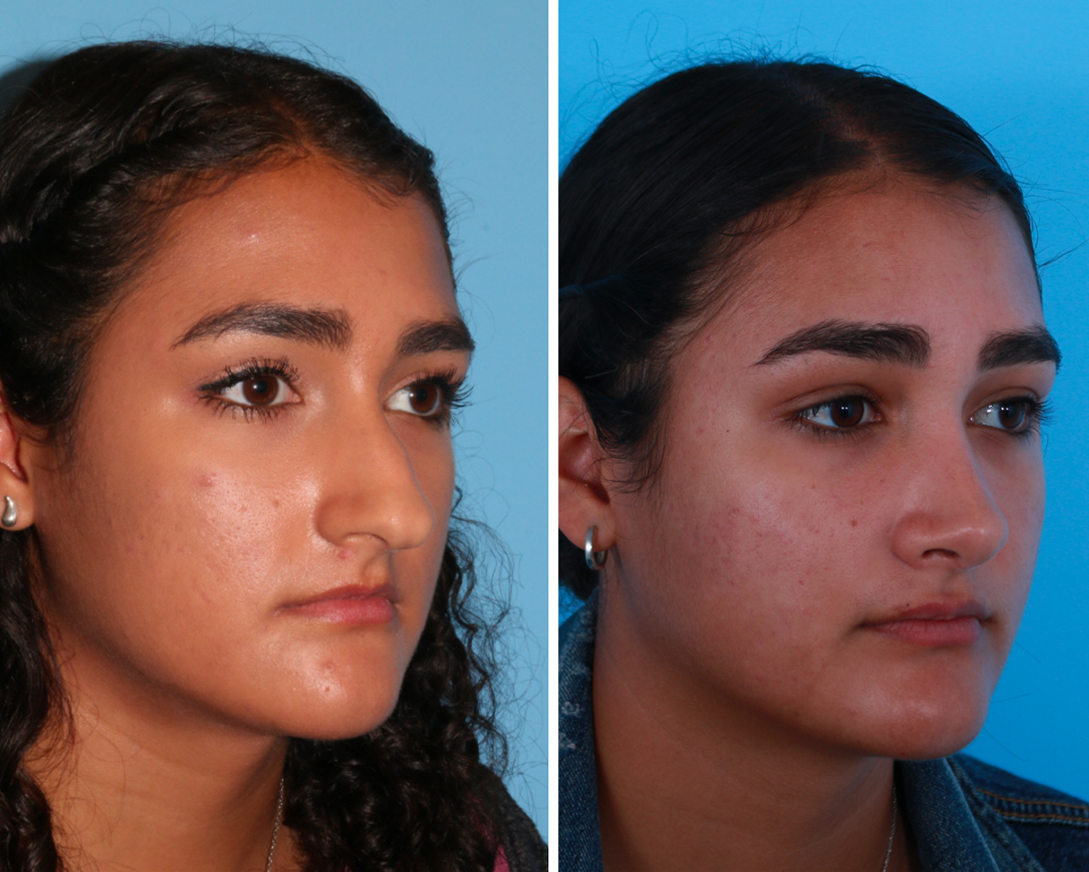 Patient 64080945 | Rhinoplasty Before & After Photos | Gold Coast ...