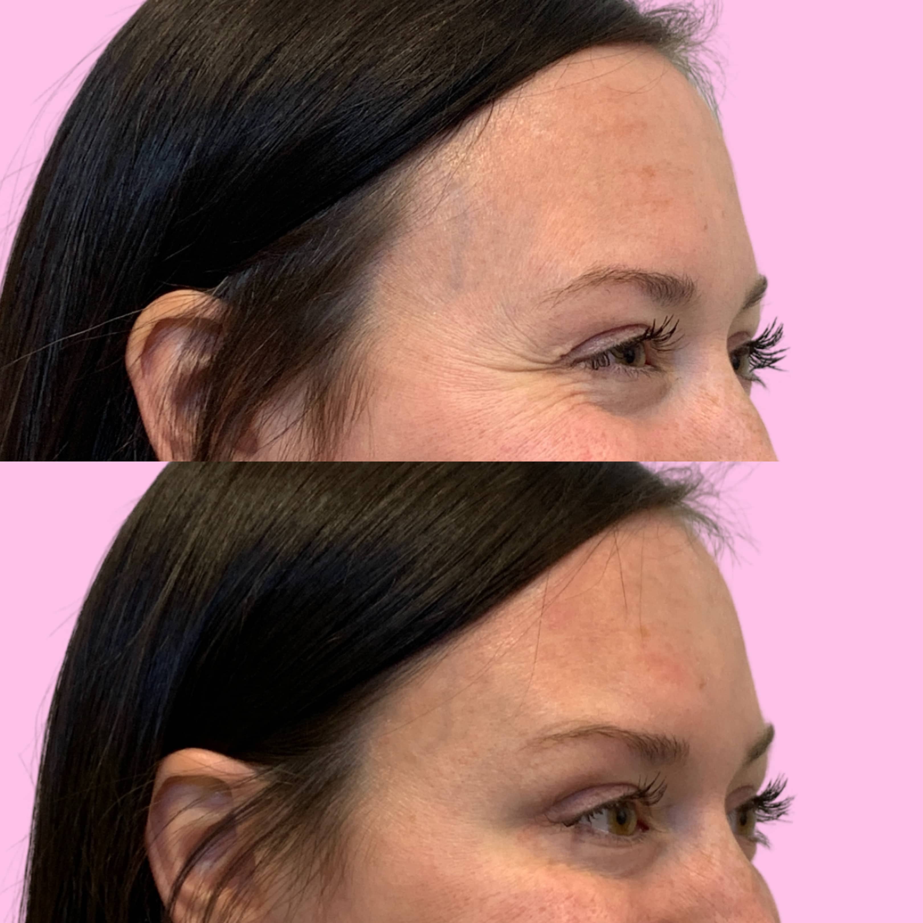 Patient 133227361 | Jeuveau Before & After Photos | Radiance