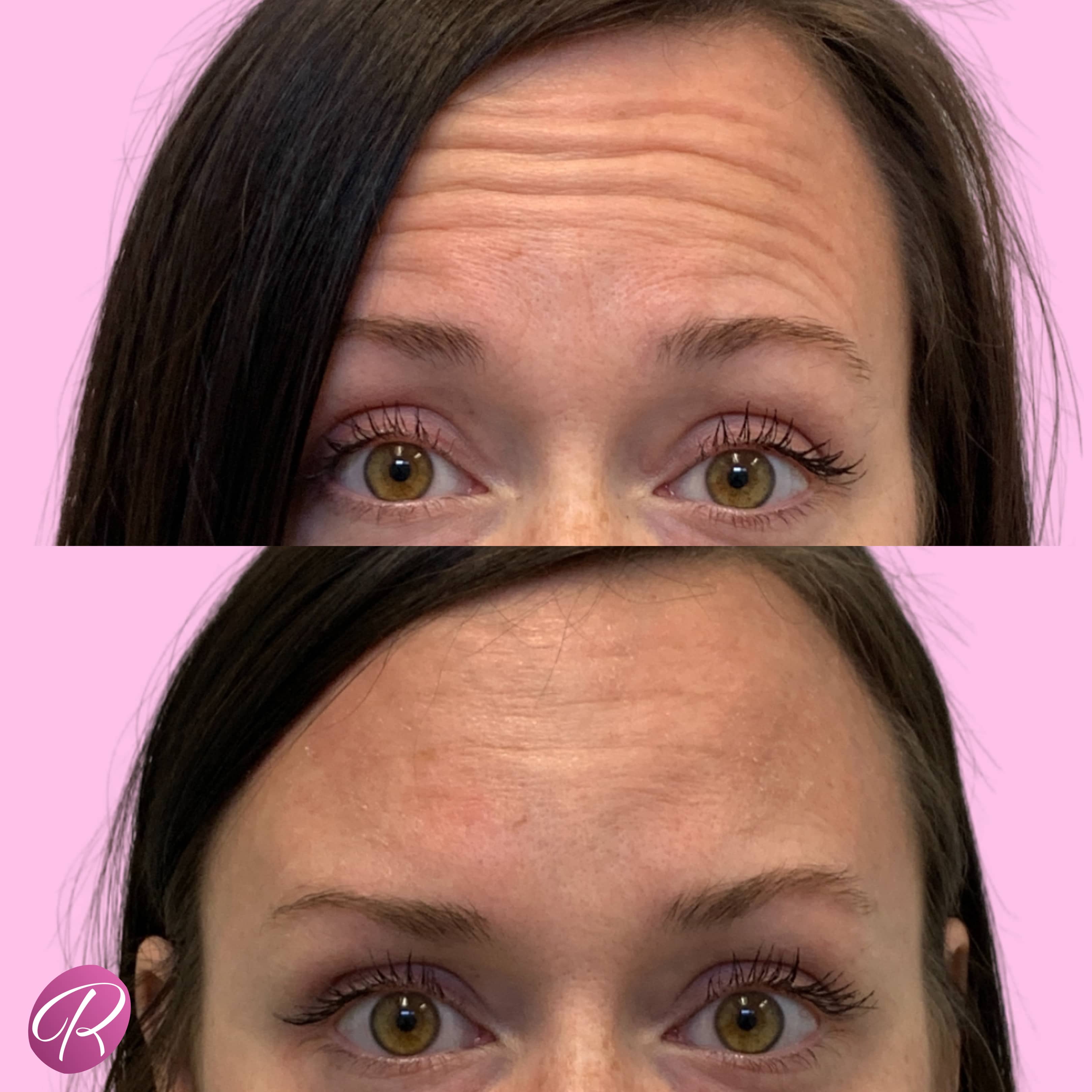 Patient 133227361 | Jeuveau Before & After Photos | Radiance