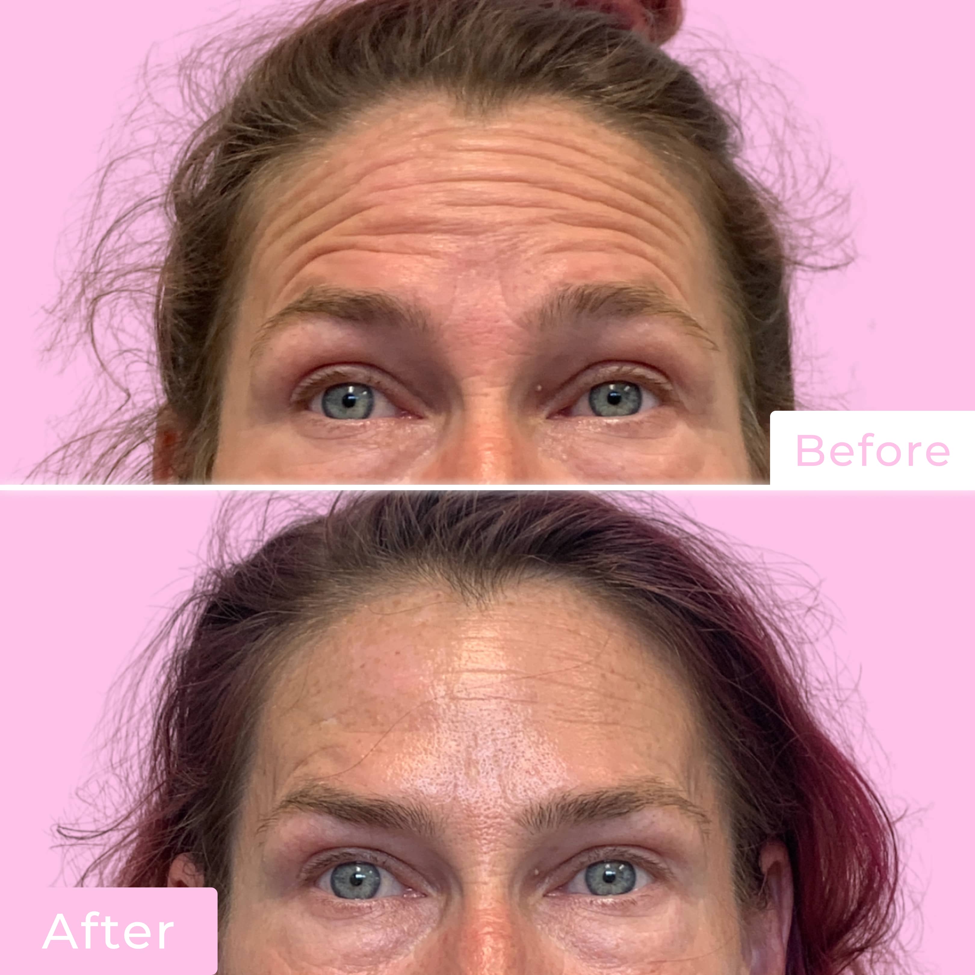 Patient 133227365 | Jeuveau Before & After Photos | Radiance