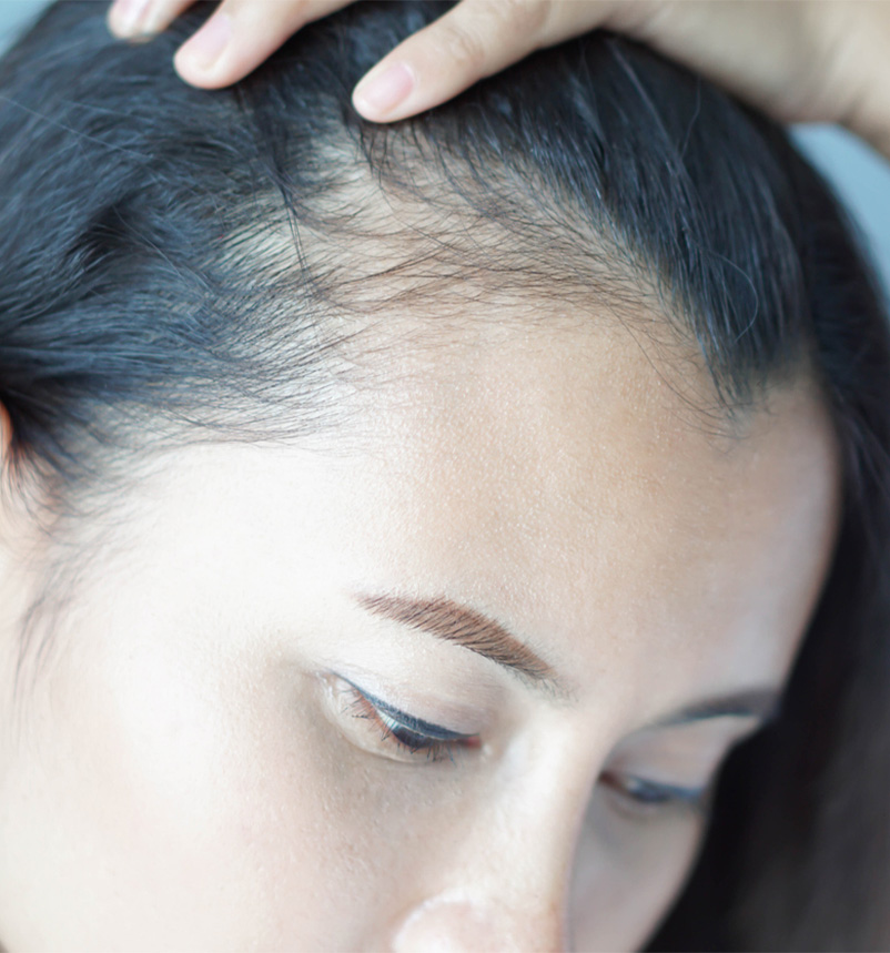 Hair Loss - Female | Integrated Aesthetics
