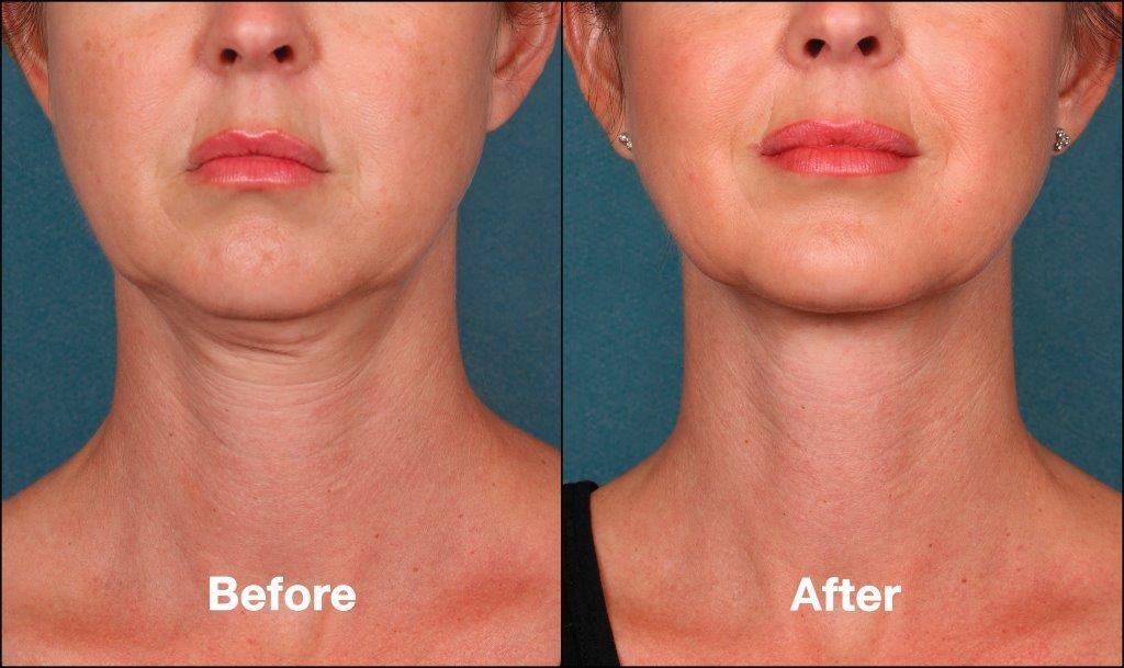 Kybella ® – The First and ONLY Injectable Double Chin Treatment ...